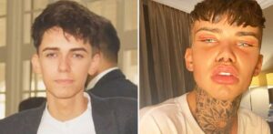 Levi Jed Murphy Before Surgery Photos, Age Height Net Worth